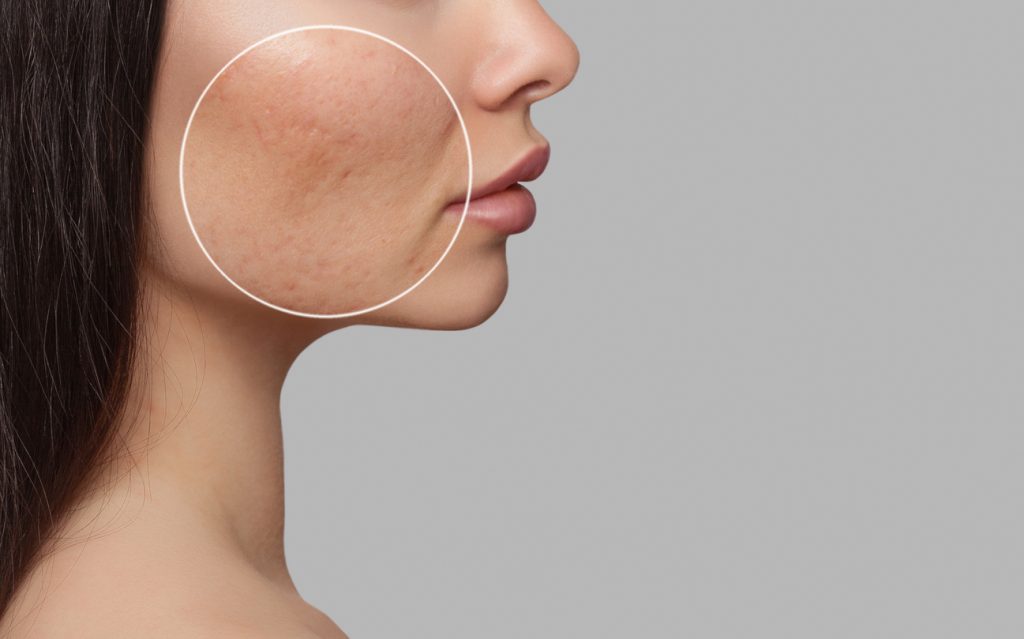 Scar Treatment in Colgate, WI — Skin Tight Aesthetics & Wellness